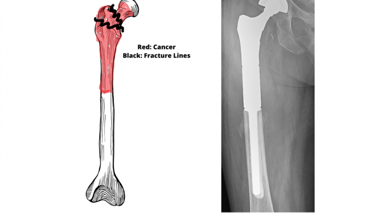 A rare case of limb saving surgery on a septuagenarian at Apollo Cancer ...